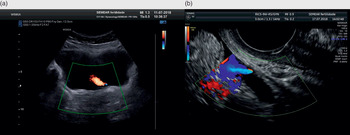 Chapter 16 – Doppler Ultrasound in Gynaecology | Obgyn Key