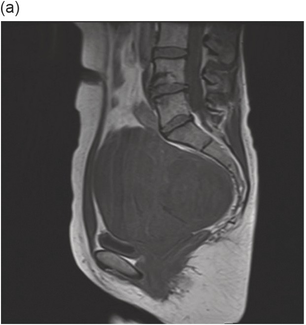 Chapter 18 – Embolization for the Management of Uterine Fibroids ...
