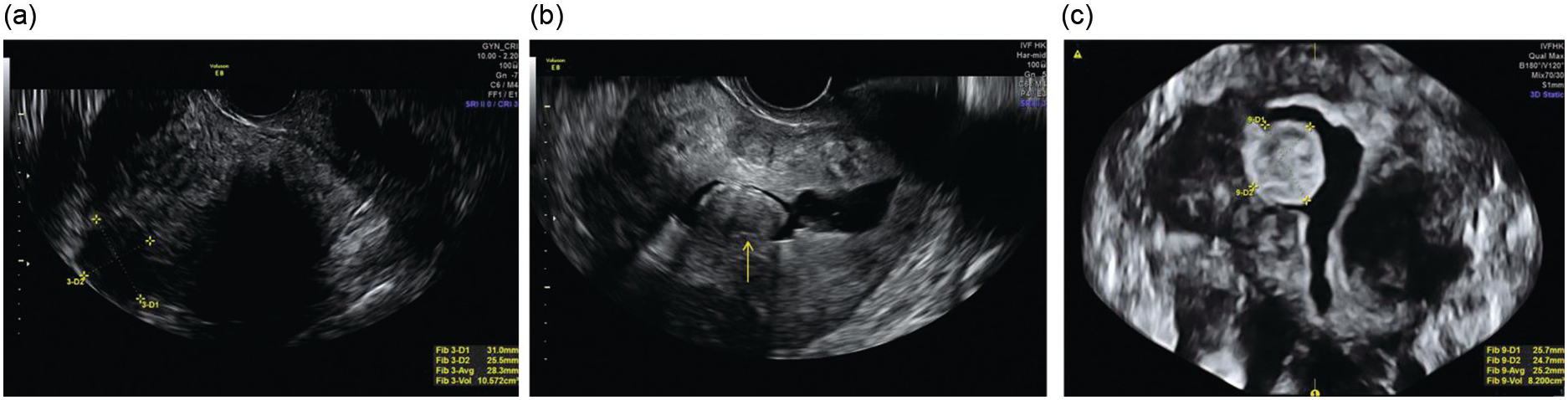 Chapter 2 – Evaluation of Uterine Fibroids Using Two-Dimensional and ...