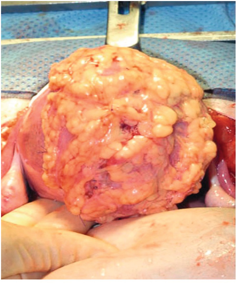 Chapter 7 – Open Myomectomy | Obgyn Key