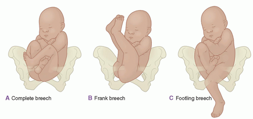 Frank Breech Presentation